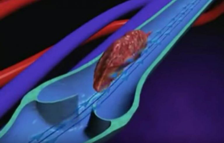 Ces 9 signaux corporels vous informent d’un caillot de sang